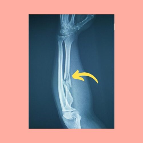 What's the Difference Between a Broken Bone and Fracture?